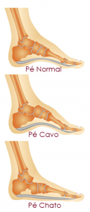 Pé Chato e Pé cavo - Os problemas que trazem a quem tem.